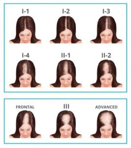 How To Measure Female Hair Loss with the Ludwig Scale – Female Hair ...
