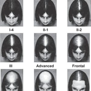 How To Measure Female Hair Loss with the Savin and Ludwig Scale ...